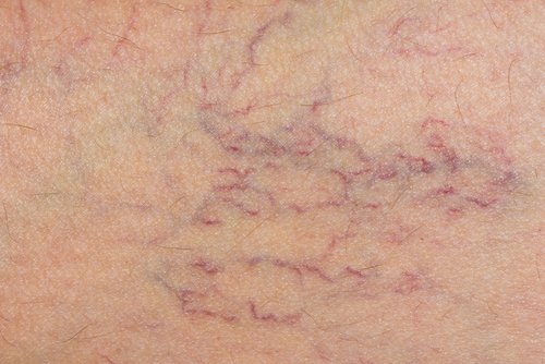 Qué son las varices - El Dr. Selles te lo explica
